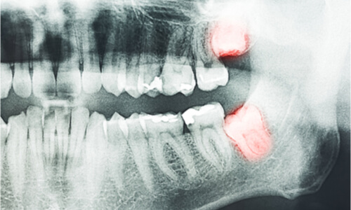 Wisdom Teeth: Migraine, Jaw Pain, And Other Symptoms